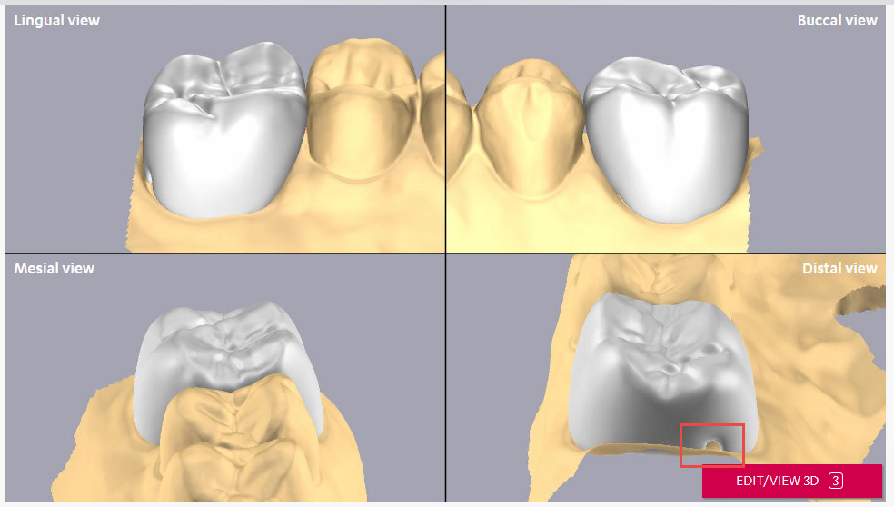 3Shape Automate - Holes coming from the margin line troubleshooting ...