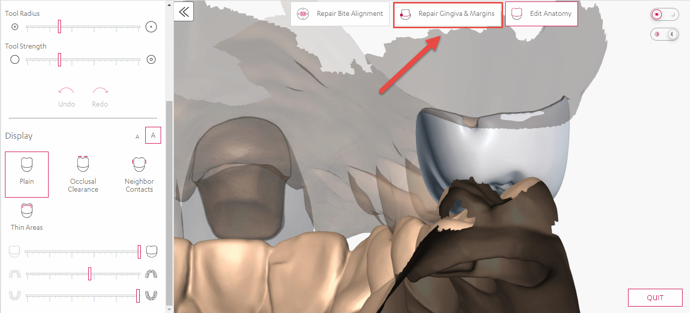 3Shape Automate - Holes coming from the margin line troubleshooting ...