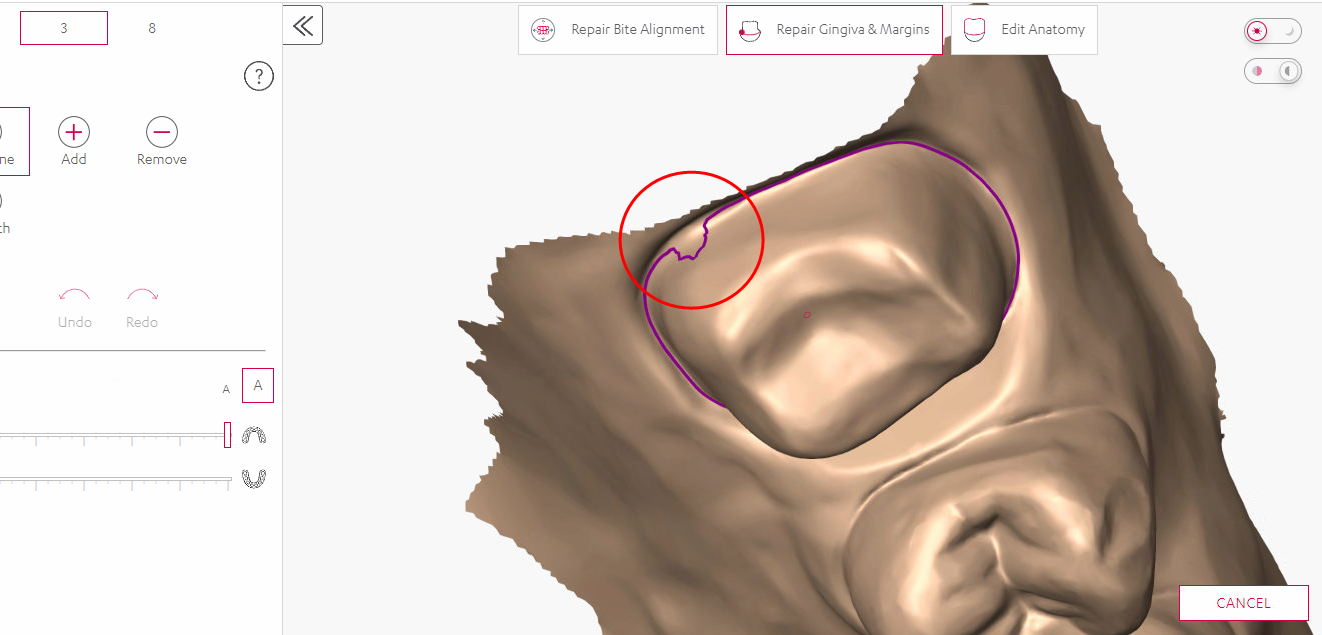 3Shape Automate - Holes coming from the margin line troubleshooting ...