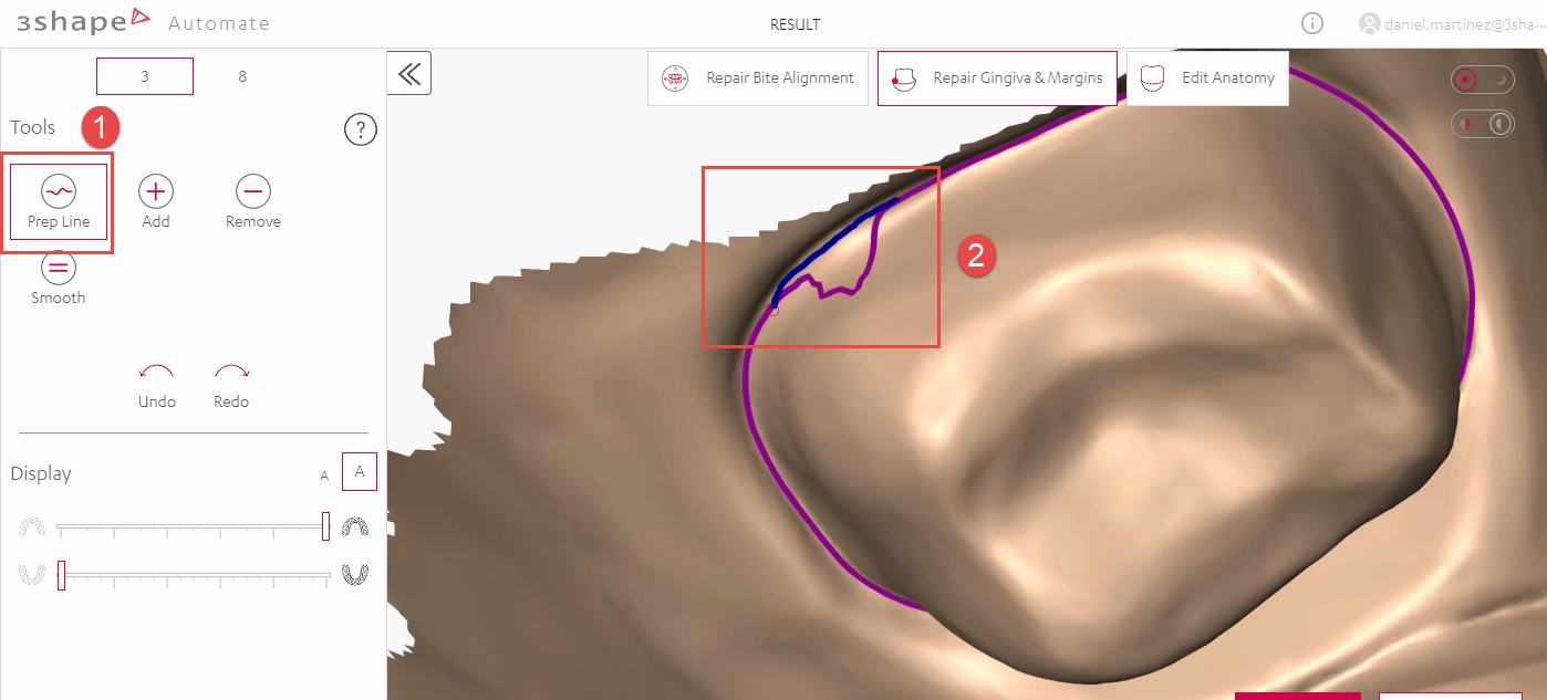 3Shape Automate - Holes coming from the margin line troubleshooting ...