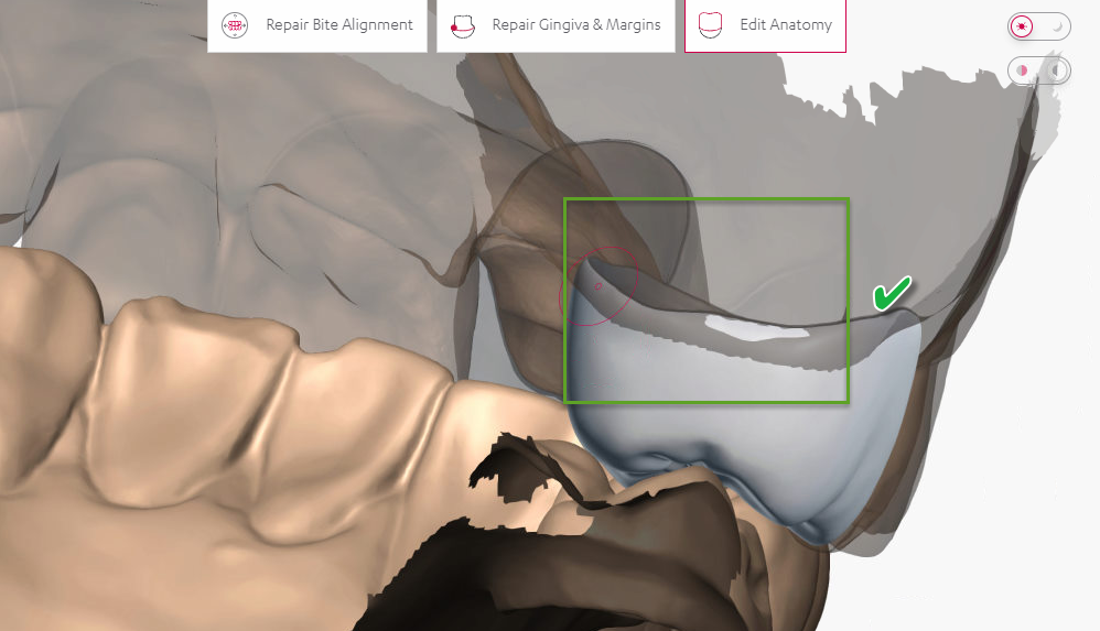 3Shape Automate - Holes coming from the margin line troubleshooting ...