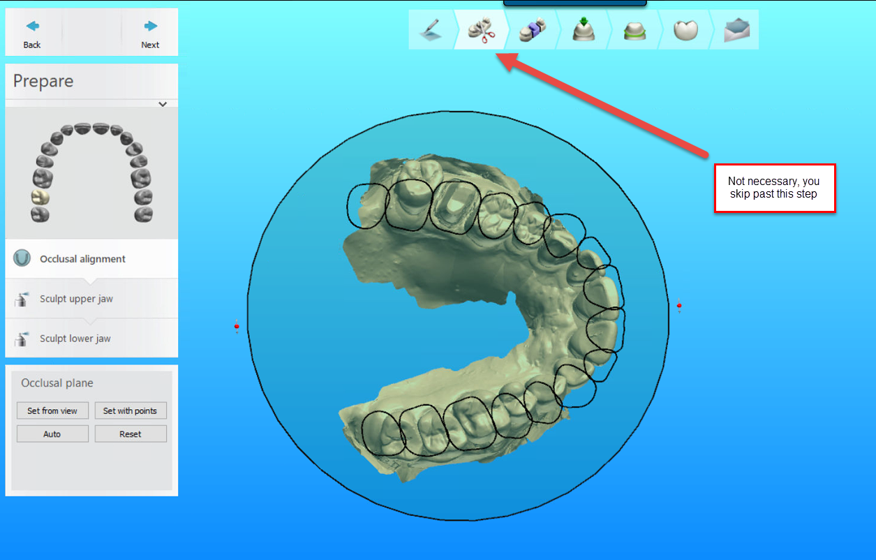 Dental Manager - How to pre-mark margins for design – 3Shape Design ...