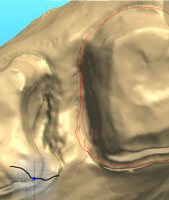 Dental Manager - How to pre-mark margins for design – 3Shape Design ...