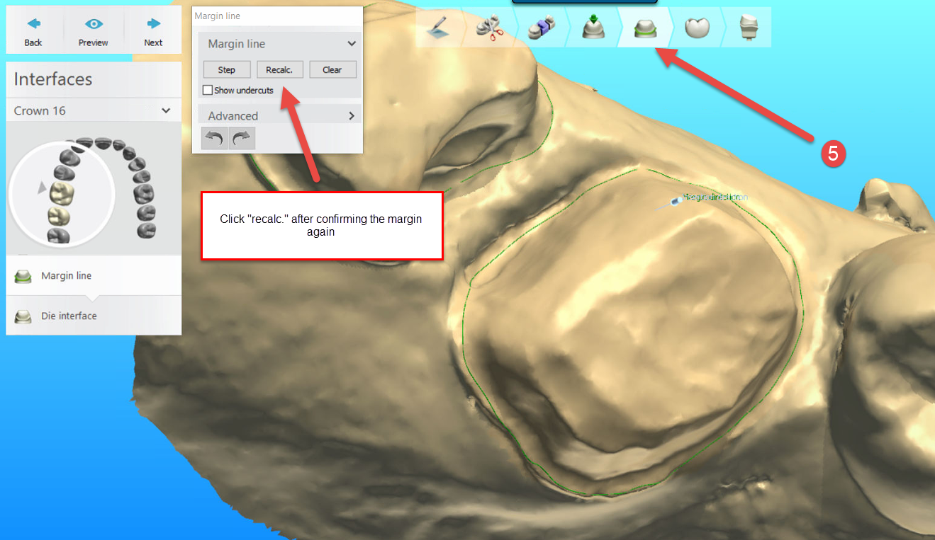 Dental Manager - How to pre-mark margins for design – 3Shape Design ...