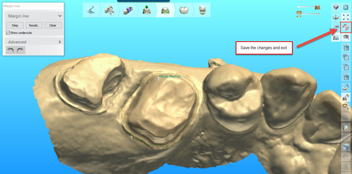 Dental Manager - How to pre-mark margins for design – 3Shape Design ...