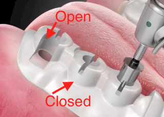 Guided Implant Surgery - Open and Closed Sleeves – 3Shape Design Services