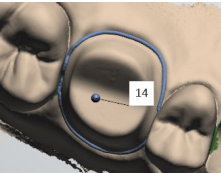 Trios - How to set the margin line automatically using Trios – 3Shape ...