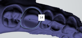 Trios - How to set the margin line automatically using Trios – 3Shape ...