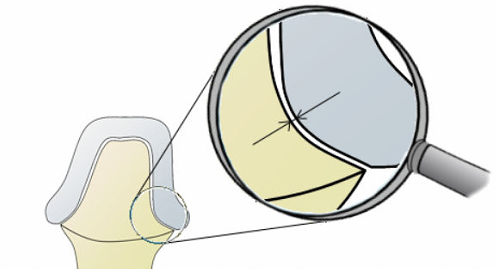 3Shape Automate - Cement Gap and Extra Cement Gap – 3Shape Design Services