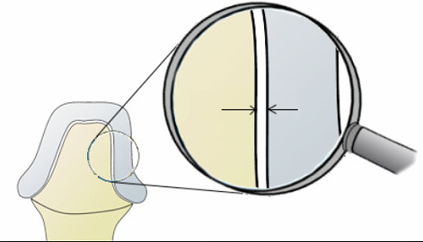 3Shape Automate - Cement Gap and Extra Cement Gap – 3Shape Design Services