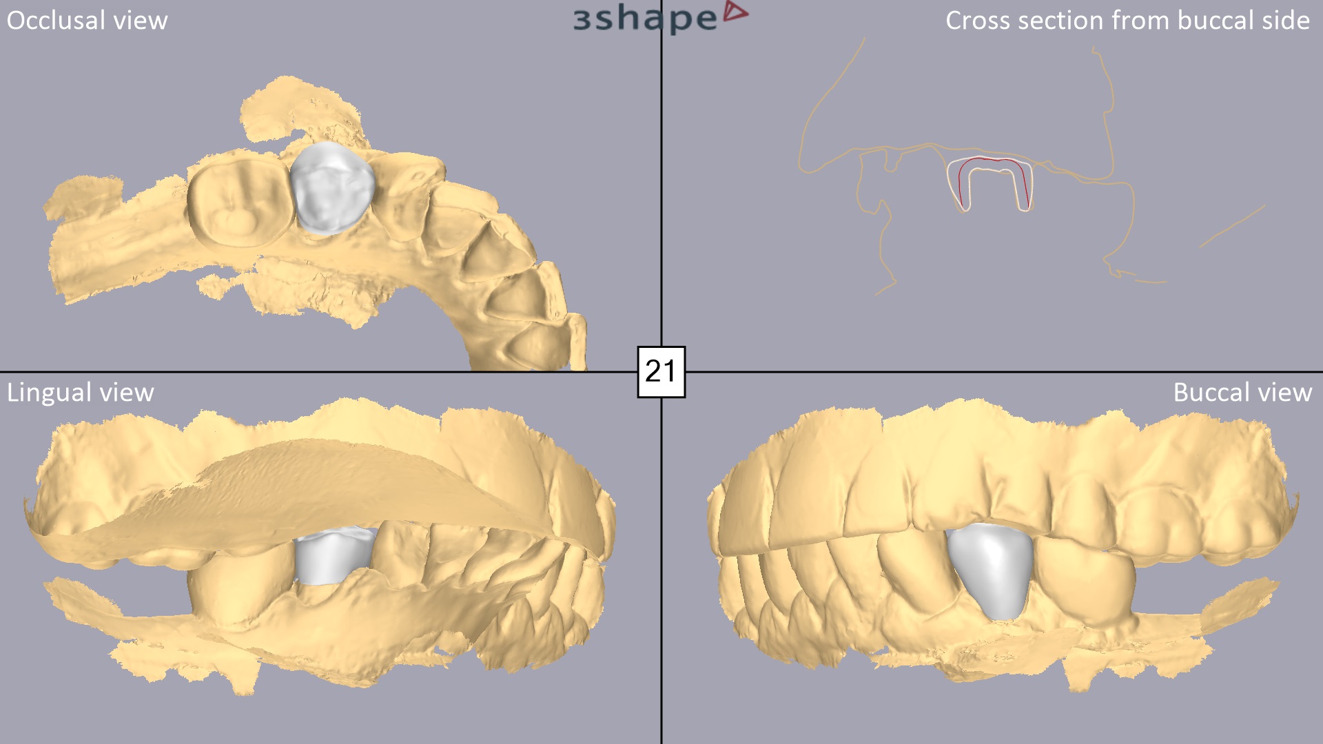 3Shape Design Service: Understanding Auto Screenshots in Crown & Bridge ...