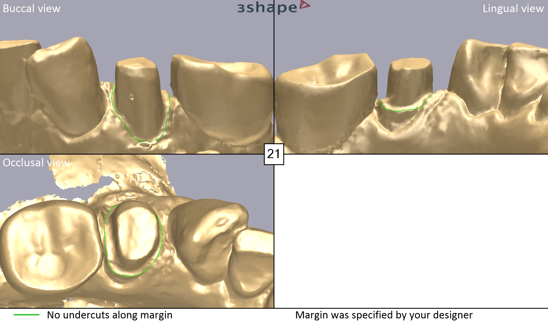 3Shape Design Service: Understanding Auto Screenshots in Crown & Bridge ...