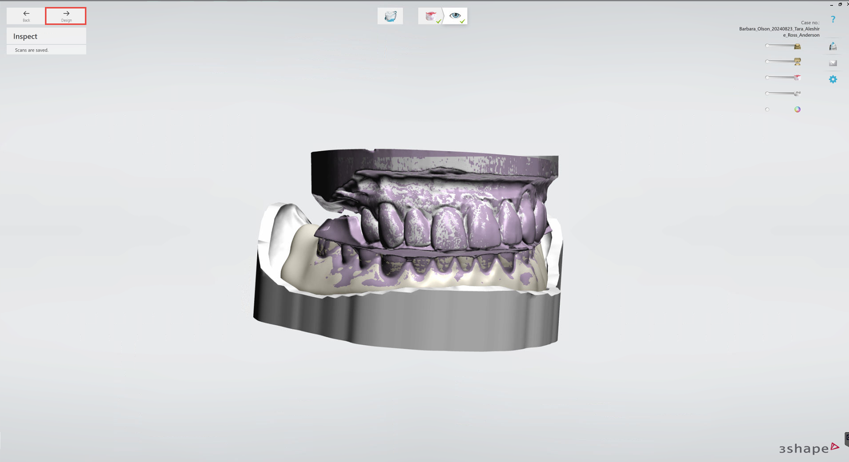 Dentures - Bite adjustments - Protocol Supported for Stone Models. – 3Shape Design Services