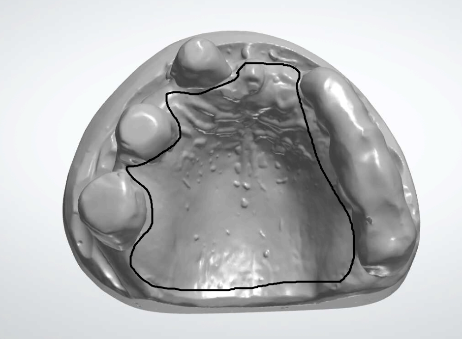 Removable Partial Dentures - Sending an RPD Case to the 3Shape Design ...