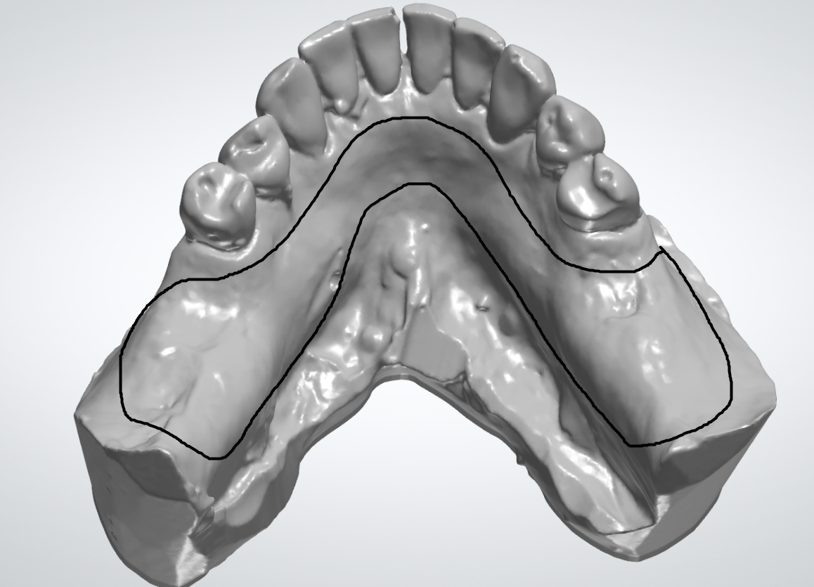 Removable Partial Dentures - Sending an RPD Case to the 3Shape Design ...