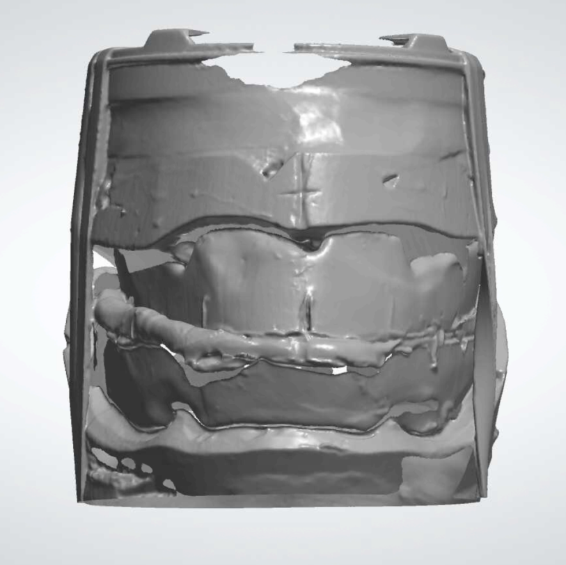 Dentures - Ivotion Denture Offering - Overview and Important Aspects ...