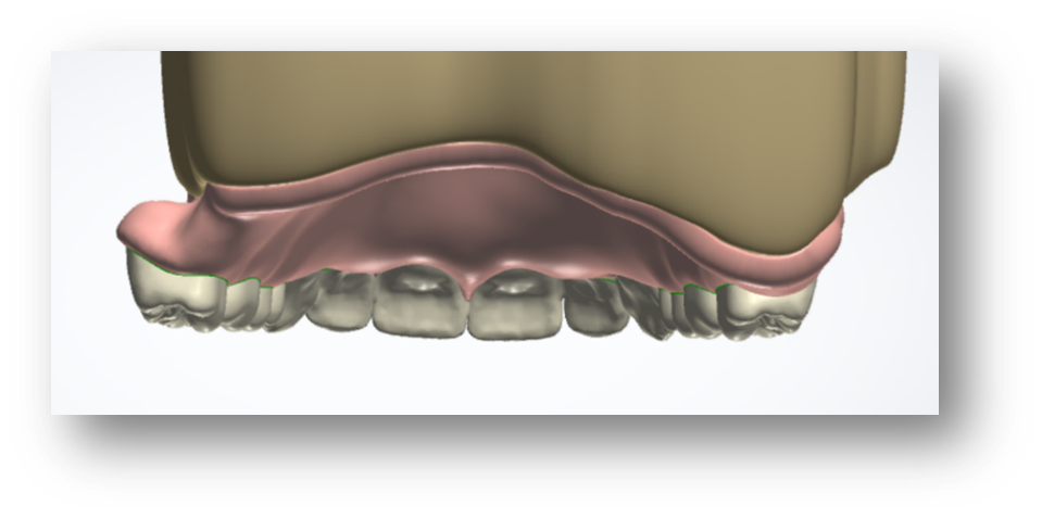 Dentures - Impression Criteria for Dentures – 3Shape Design Services