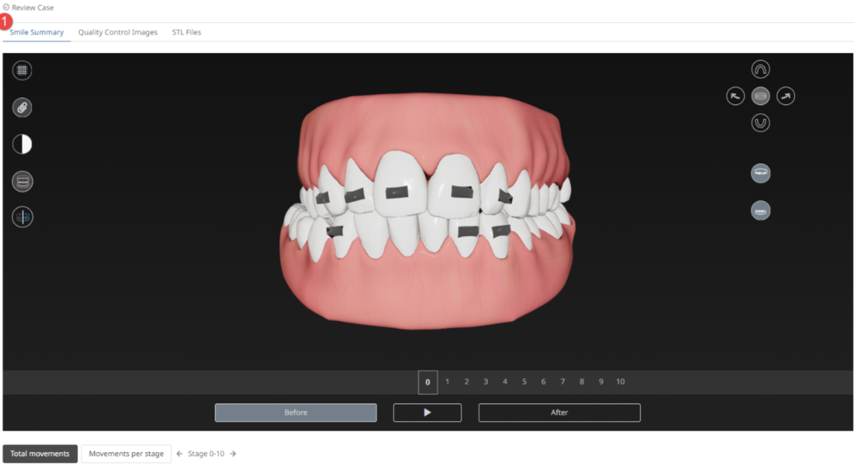 Clear Aligners - How to View Previous Versions to Make a Final Decision – 3Shape Design Services