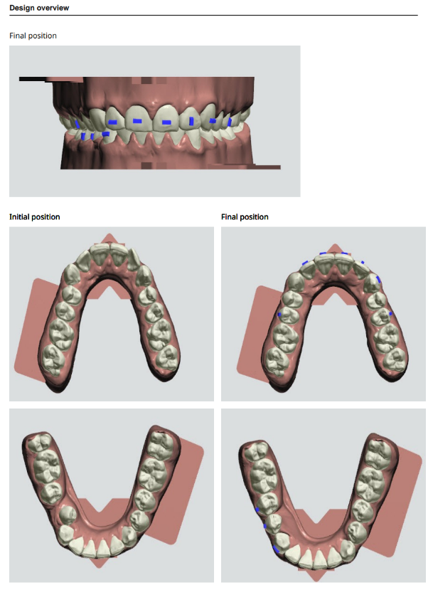 Clear Aligners - Treatment Summary Overview – 3Shape Design Services