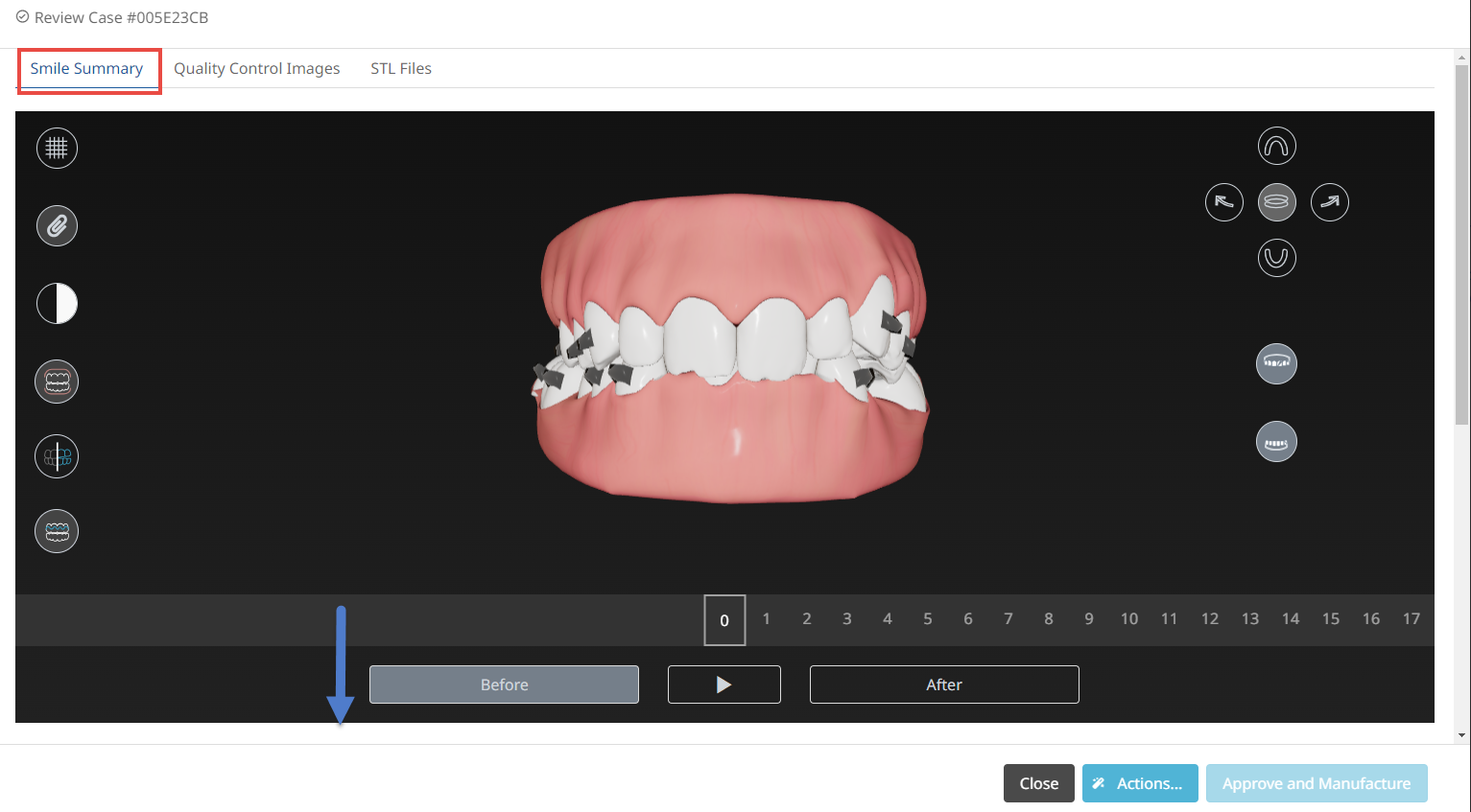 Clear Aligners - Treatment Summary Overview – 3Shape Design Services
