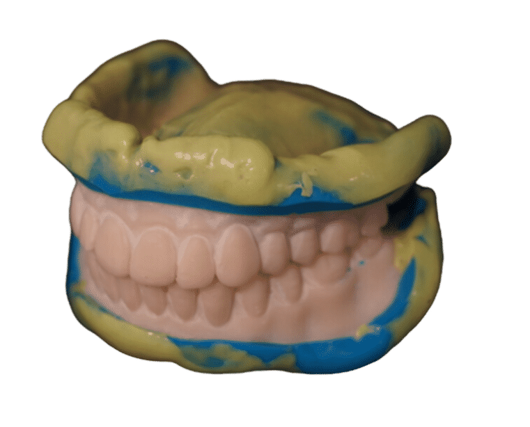 Dentures - Requirements for the existing denture to be used as a ...