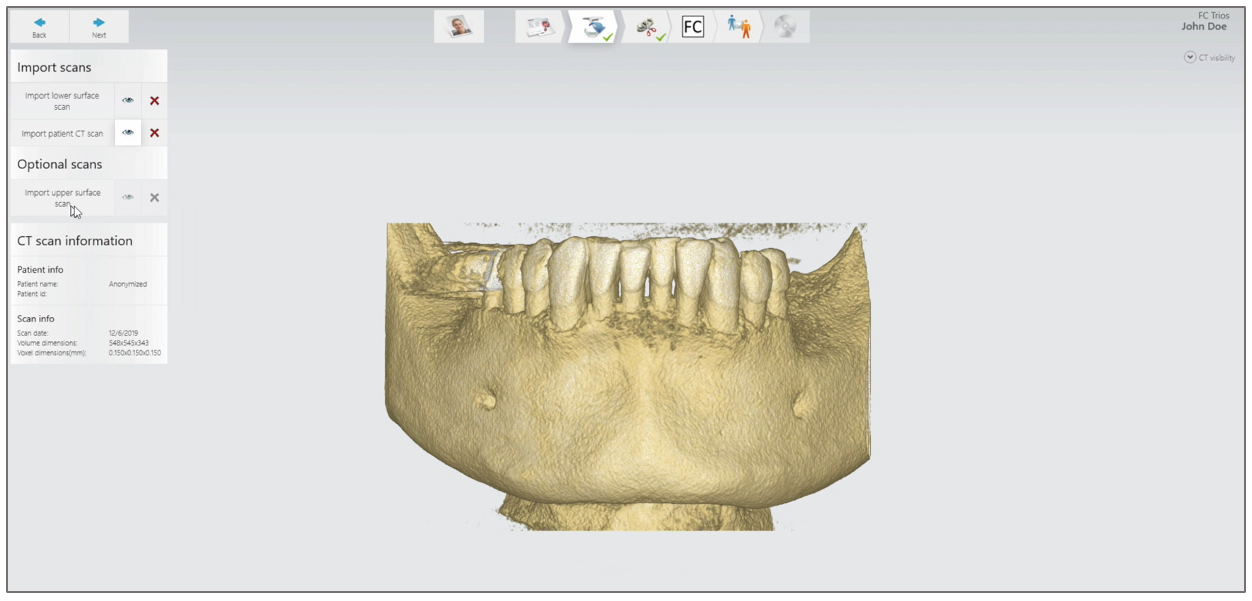 Guided Implant Surgery - 3Shape Communicate workflow for Guided Surgery ...