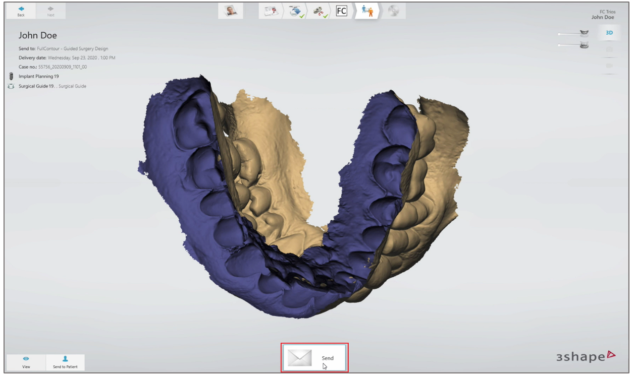 Guided Implant Surgery - 3Shape Communicate workflow for Guided Surgery ...
